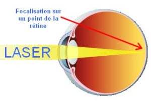Sécurité LASER - Protection des yeux - Framboise 314, le Raspberry Pi à ...